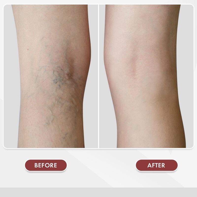 Vascovein kem bôi và viên uống giãn tĩnh mạch - Vitamin tổng hợp ...